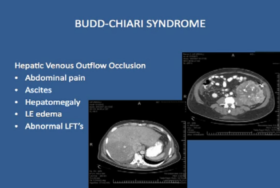 Budd-Chiari Syndrome Overview 2 – Livers With Life